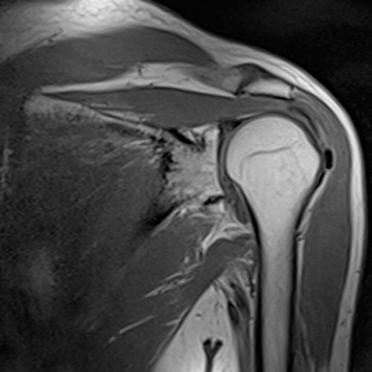 Resonancia Magnética de Hombro - Resonancia Magnética Panamá