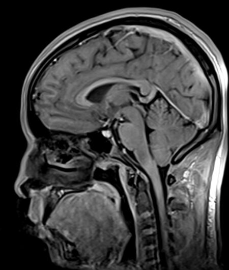 Resonancia Magnética Cerebral con Contraste